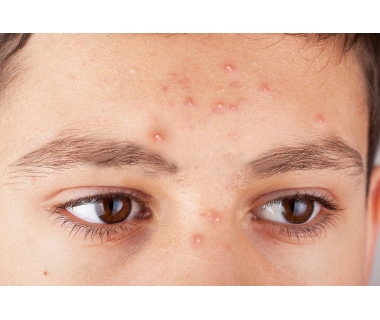 Acné facial - Dermatologia-us.com